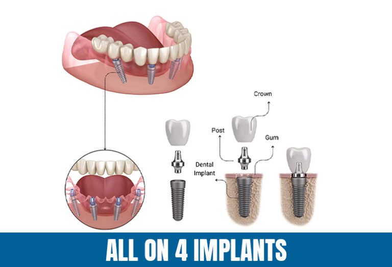 Explore Best Teeth Implants Types | SAIGON IMPLANT CENTER