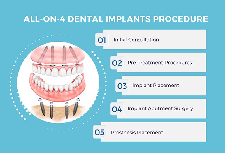 ALL ON 4 IMPLANT AT SAIGON DENTAL IMPLANTS CENTER - Saigon Dental Implants Center - The Best ...