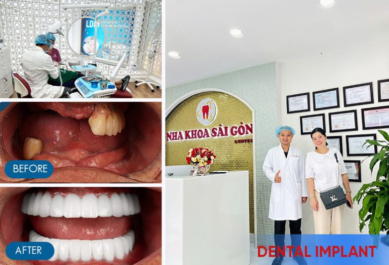IMPLANT BRIDGE AT SAIGON IMPLANT CENTER IN VIETNAM | SAIGON IMPLANT CENTER