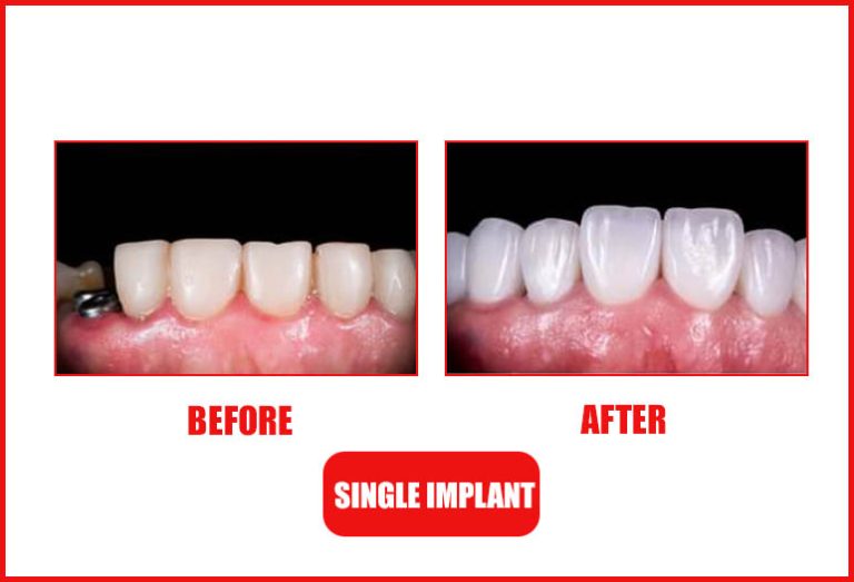 SINGLE IMPLANT AT SAIGON IMPLANT DENTAL CLINIC - Saigon Implant Dental ...