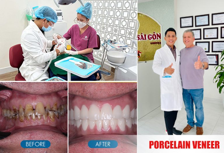 How Much Does Full Mouth Reconstruction Cost in Ho Chi Minh City ...