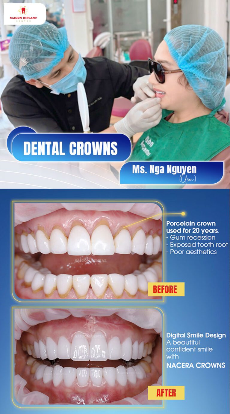 Dental Crowns in Vietnam: Types, Procedure and Cost | SAIGON IMPLANT CENTER