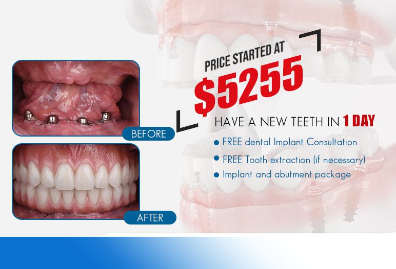 Full mouth Dental Implant Prices list in Ho Chi Minh City, Vietnam ...