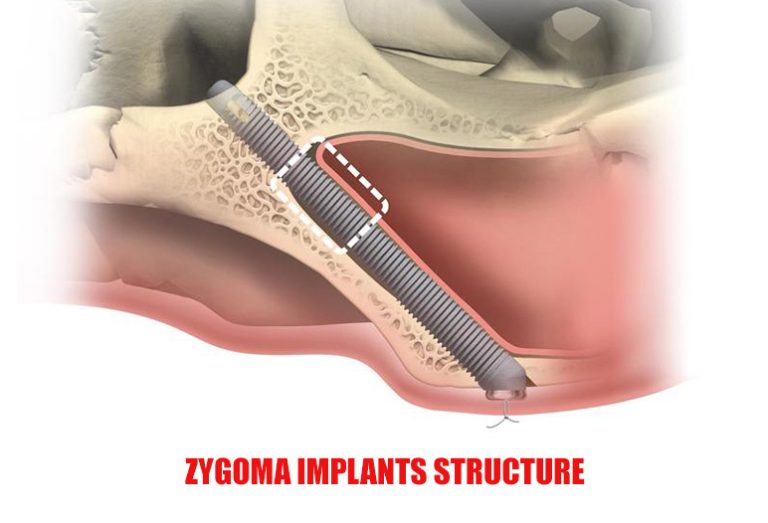 Zygoma Implants for Upper Jaw: Advantages, Benefits, Procedure, Cost ...