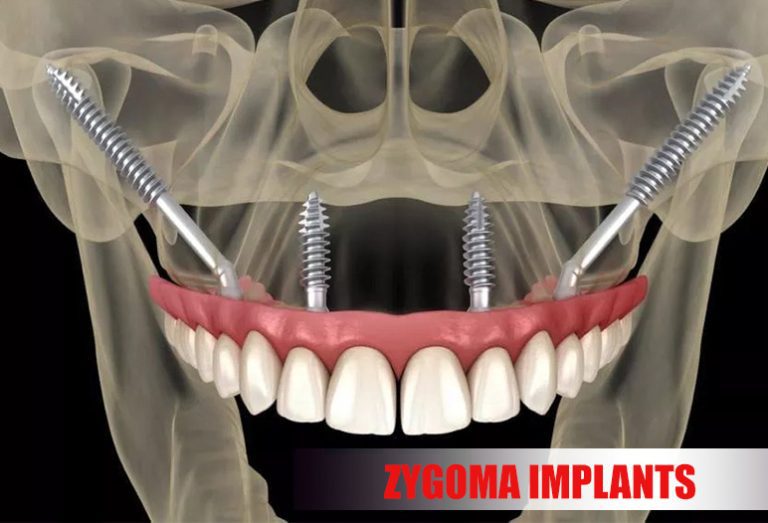 Zygoma Implants for Upper Jaw: Advantages, Benefits, Procedure, Cost ...