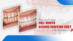 How Much Does Full Mouth Reconstruction Cost in Ho Chi Minh City ...