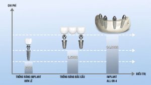 Dental Care - Understanding Immediate Loading of Dental Implants ...