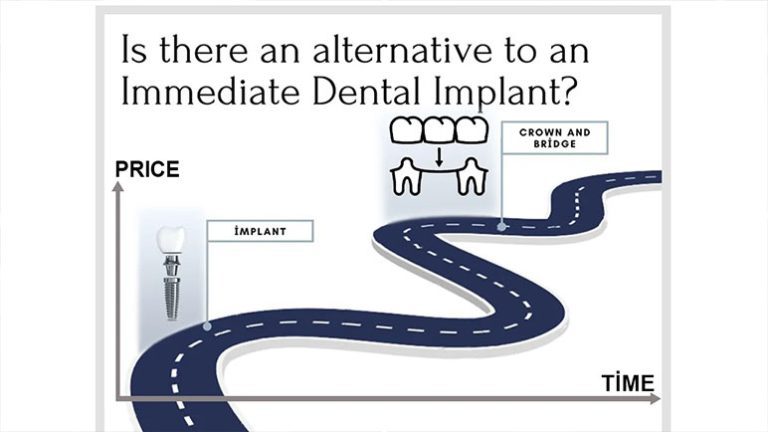Dental Care - Understanding Immediate Loading of Dental Implants | SAIGON IMPLANT CENTER