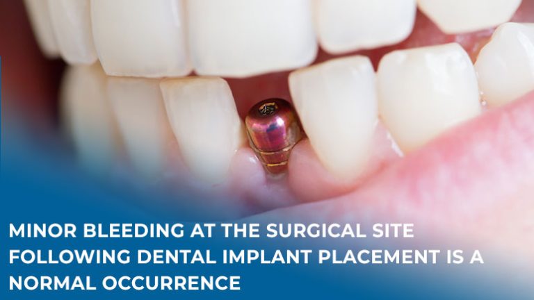 Can Tooth Implants Cause Health Problems? | SAIGON IMPLANT CENTER