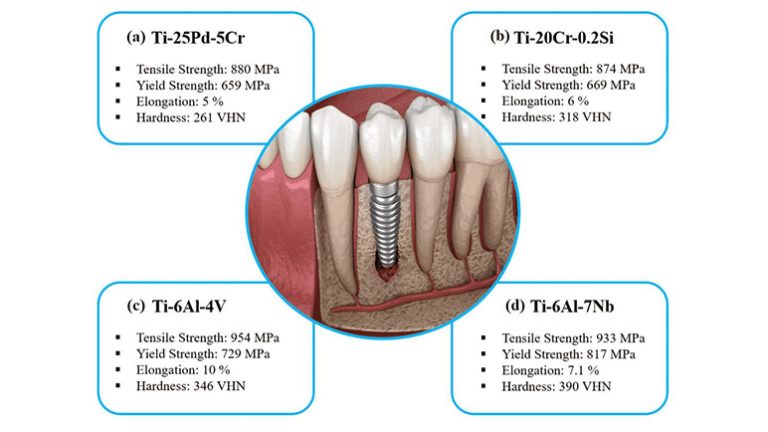 Titanium tooth implant cost: What you should expect to pay for a ...
