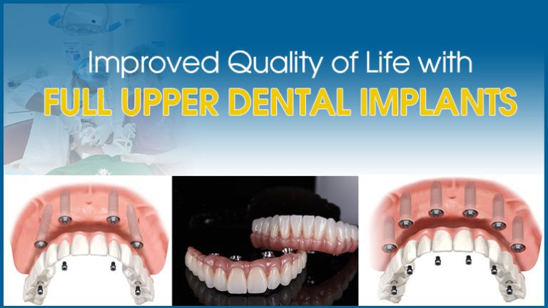 Improved Quality Of Life With Full Upper Dental Implants | SAIGON ...