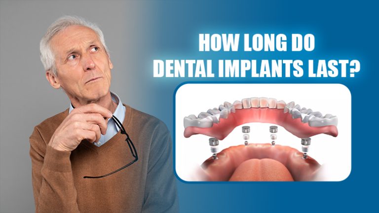 How Long Do Dental Implants Last Saigon Implant Center