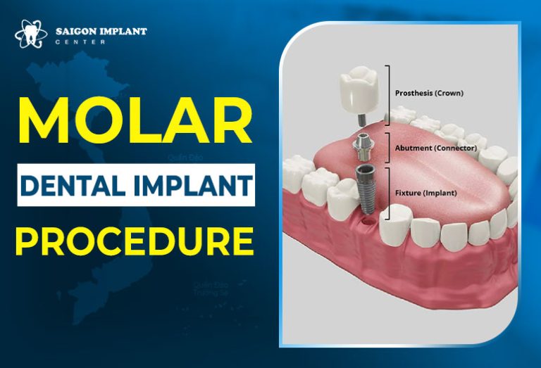 Molar dental implant procedure | SAIGON IMPLANT CENTER