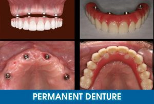 Permanent Dentures: Solutions For Missing Teeth | SAIGON IMPLANT CENTER