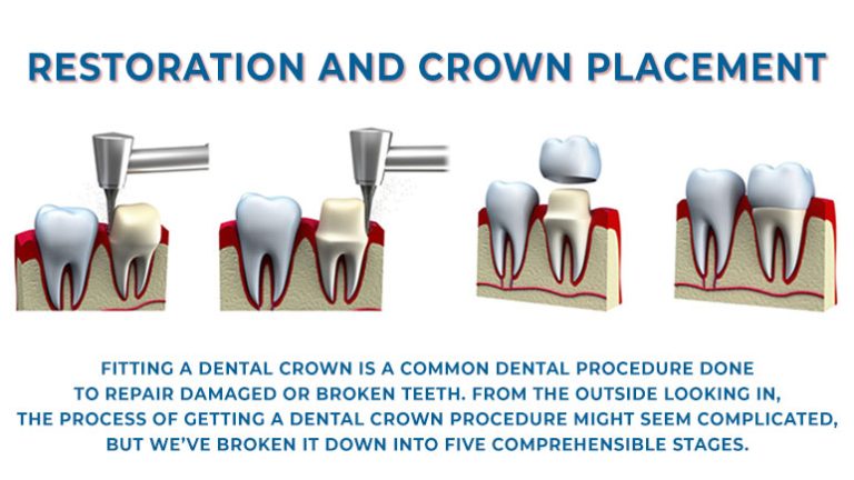 What Is A Basal Implant? A Complete Guide | SAIGON IMPLANT CENTER