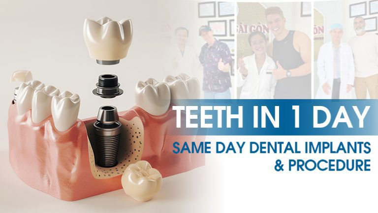 Teeth In 1 Day: Same Day Dental Implants & Procedure | SAIGON IMPLANT ...