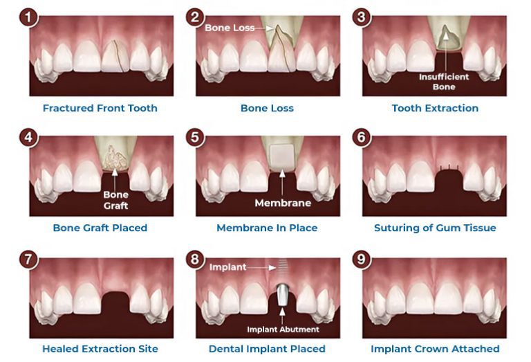 Bone Graft And Implant - What Is More Painful? | SAIGON IMPLANT CENTER