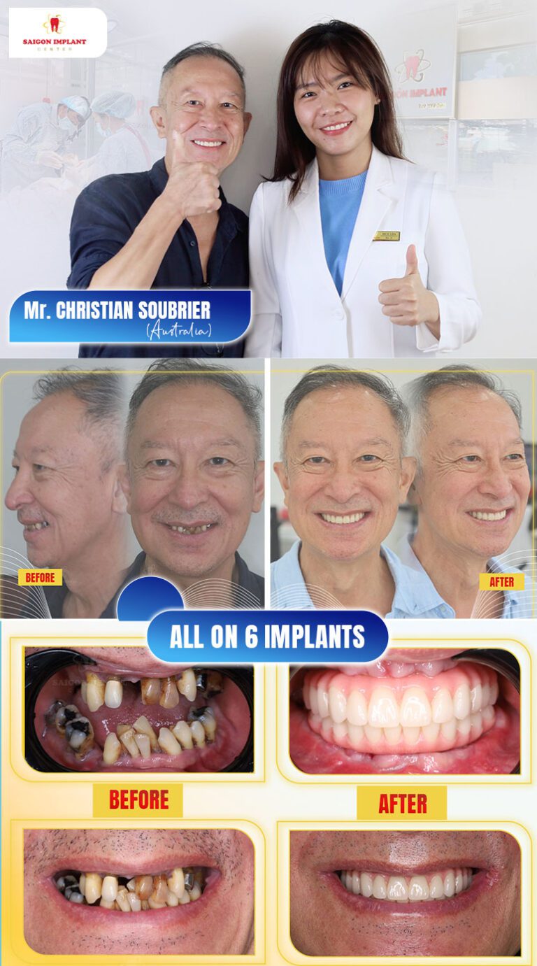 Whole Mouth Renew Dental Implants In Just 1 Day In Vietnam | SAIGON ...