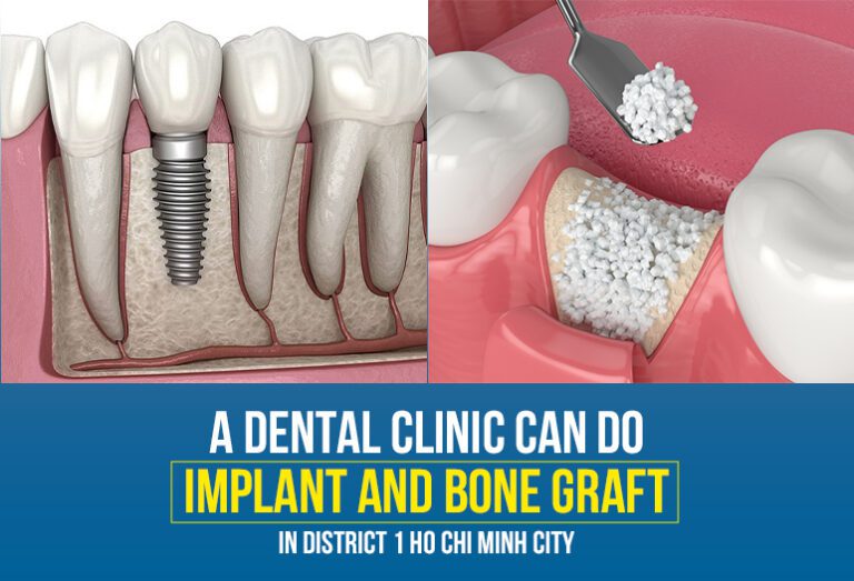 A Dental Clinic Can Do Implant And Bone Graft In District 1 Ho Chi Minh ...