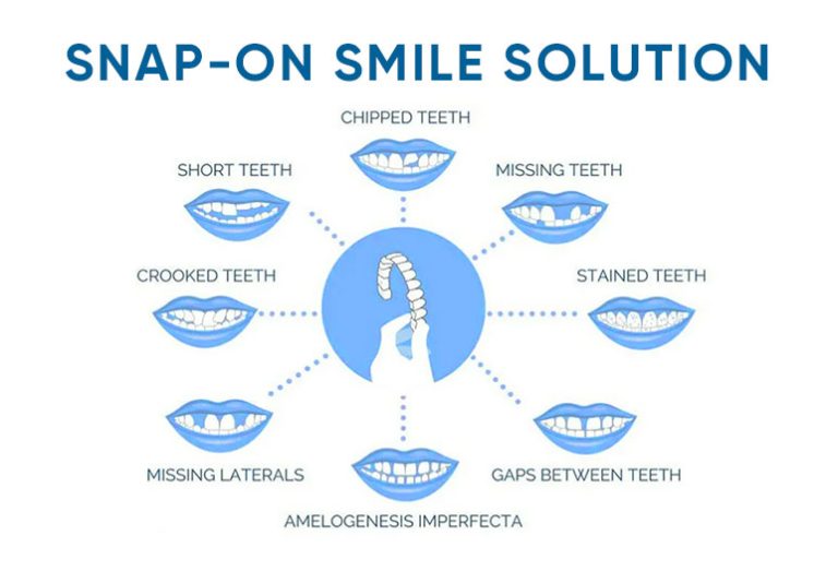 Snap on Smile Veneers - Cost, Reviews & How They Work | SAIGON IMPLANT ...