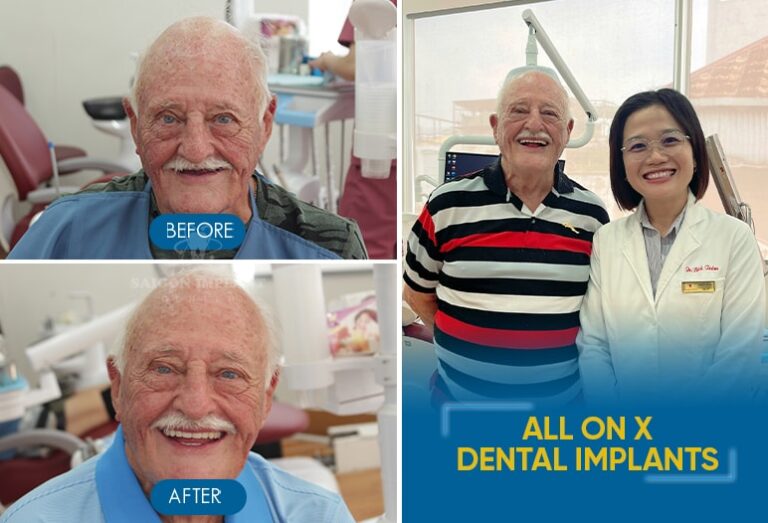 Understanding All on 6 Dental Implants - Saigon Dental Implants Center