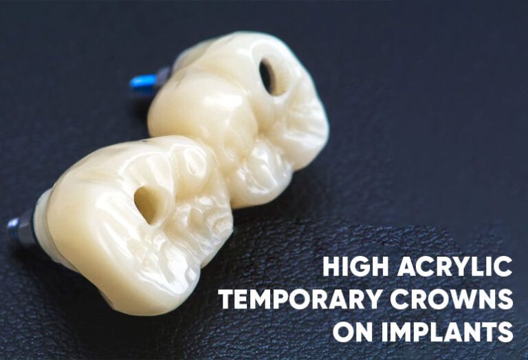 How long does a temporary implant crown last? | SAIGON IMPLANT CENTER