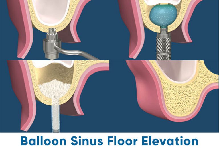 What is a Sinus Lift in Dentistry | SAIGON IMPLANT CENTER