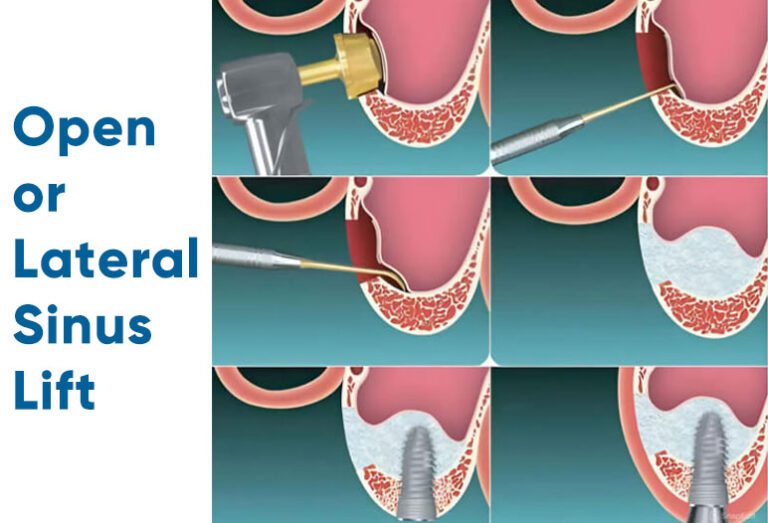 What is a Sinus Lift in Dentistry | SAIGON IMPLANT CENTER