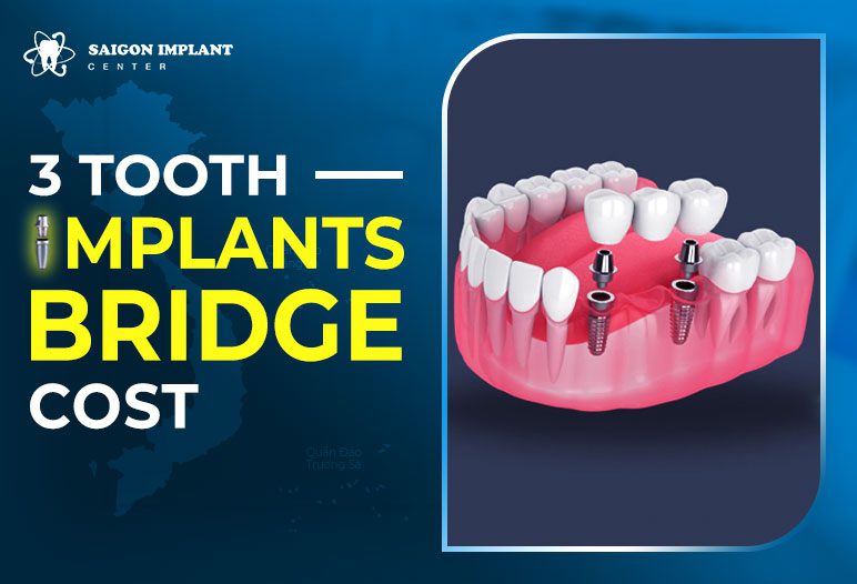 3 Tooth Implant Bridge Cost: Comparing Options For Replacing Multiple ...